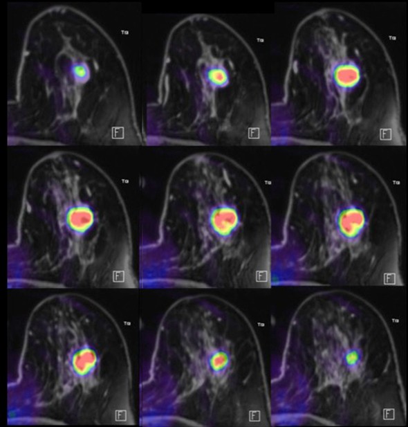 The role of positron emission tomography in breast cancer: a short ...