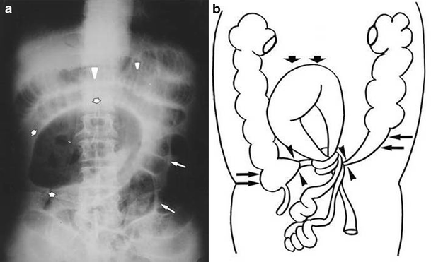 Ileosigmoid Knot | SpringerLink