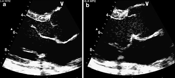Mitral Valve Disease in Marfan Syndrome and Related Disorders ...