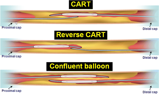 Advances in the Management of Coronary Chronic Total Occlusions ...