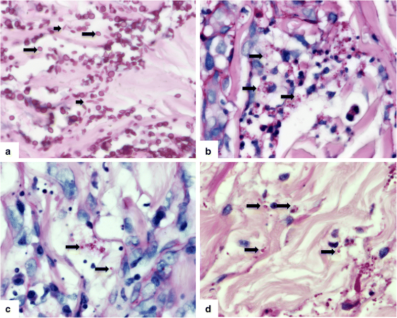 Emergomyces: a New Genus of Dimorphic Fungal Pathogens Causing ...