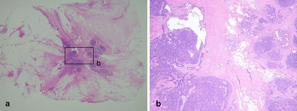 Six cases showing radial scar/complex sclerosing lesions of the breast ...