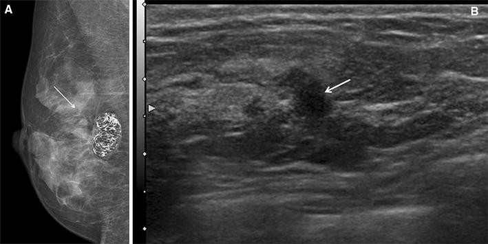 What we should know in mammography after reduction mammoplasty and ...