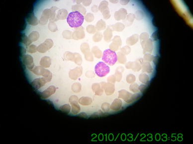 Alder–Reilly Anomaly in Hurler’s Syndrome in a Neonate: A Rare Case ...