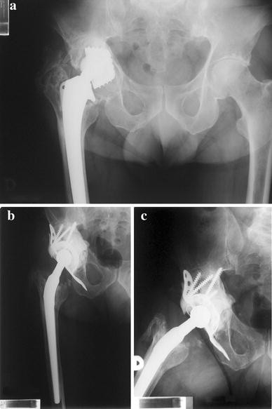 Total hip arthroplasty revision in elderly people with cement and Burch ...