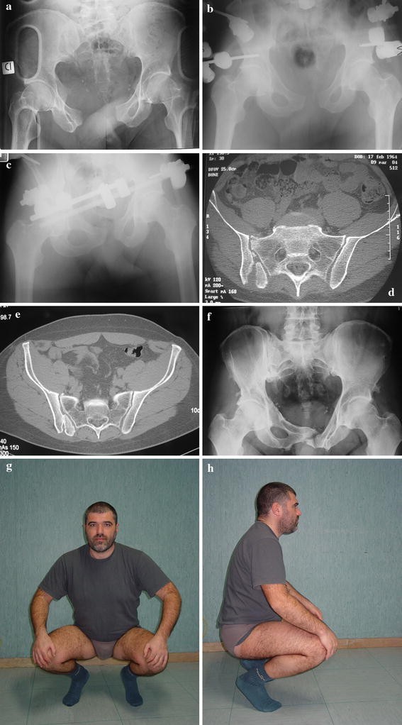 External fixation in pelvic fractures | SpringerLink