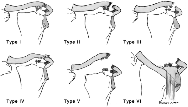 Modified Phemister procedure for the surgical treatment of Rockwood ...