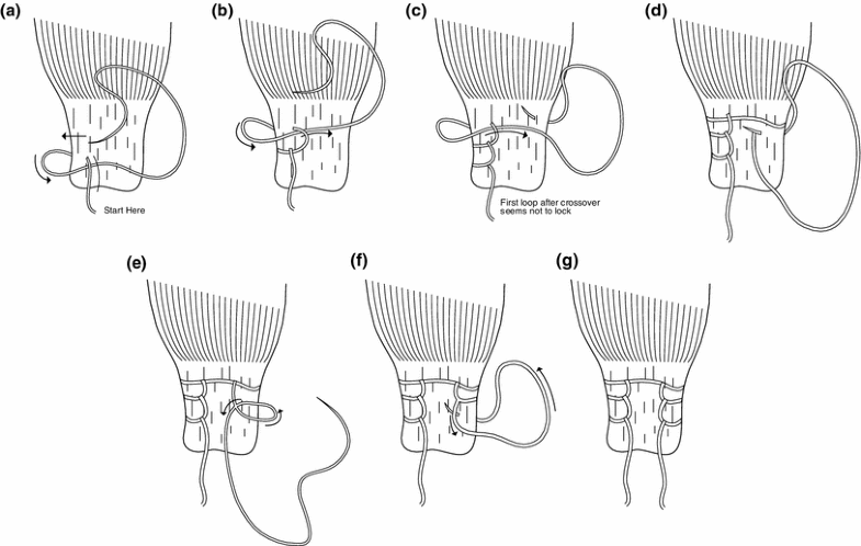 The ruptured Achilles tendon: a current overview from biology of ...