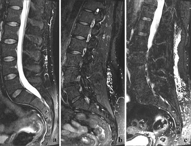 Lumbar subcutaneous edema and degenerative spinal disease in patients with low back pain: a ...