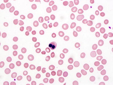 Congenital dyserythropoietic anemia type II (CDA II) diagnosed in an ...