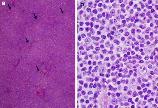 Concurrent CD5-negative small lymphocytic lymphoma (SLL) and CD5 ...