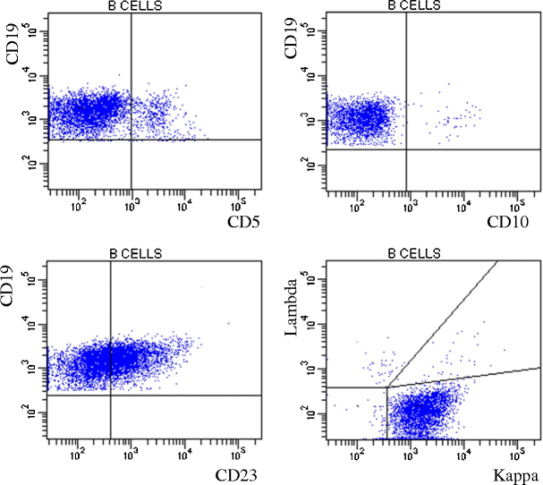 Concurrent CD5-negative small lymphocytic lymphoma (SLL) and CD5 ...