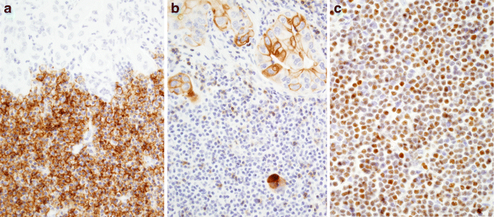 Concurrent CD5-negative small lymphocytic lymphoma (SLL) and CD5 ...