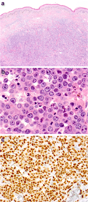 The diversity of diffuse large B-cell lymphoma in extranodal sites ...