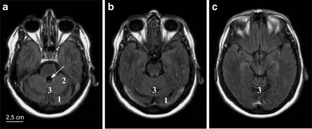 Pathoanatomy of Cerebellar Degeneration in Spinocerebellar Ataxia Type ...