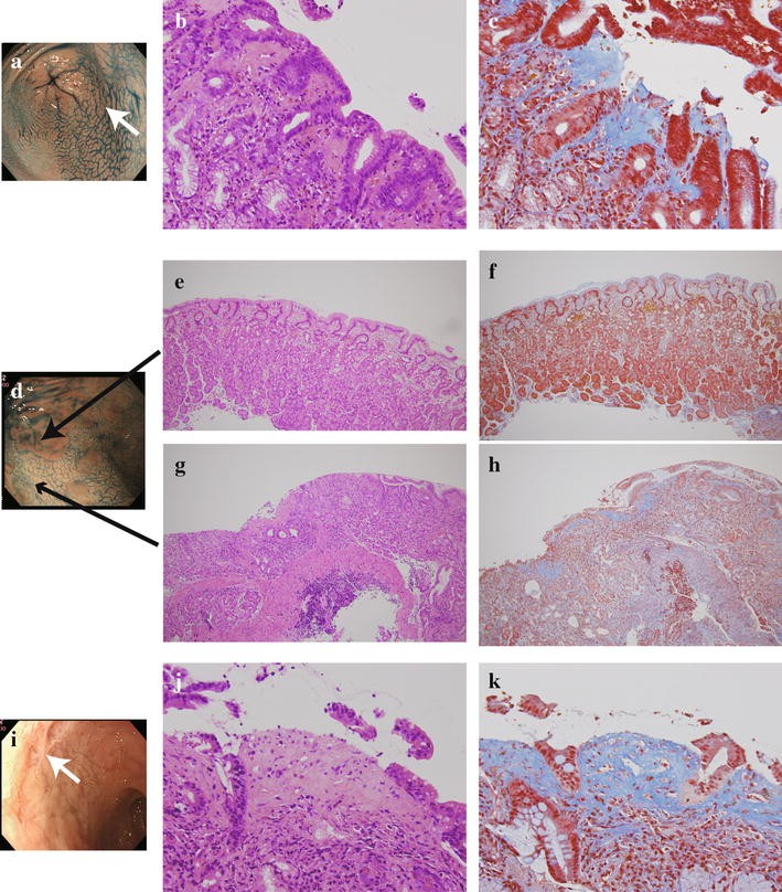 Collagenous gastroduodenitis coexisting repeated Dieulafoy ulcer: A ...