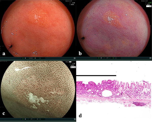 Linked color imaging technology facilitates early detection of flat ...