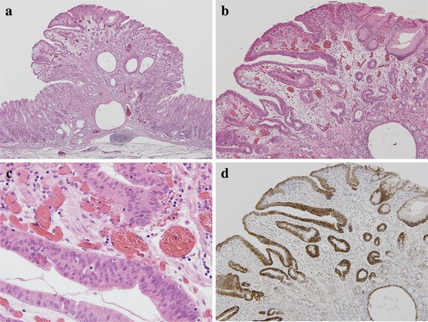 Gastric adenocarcinoma coexisting with a reddish semipedunculated polyp ...