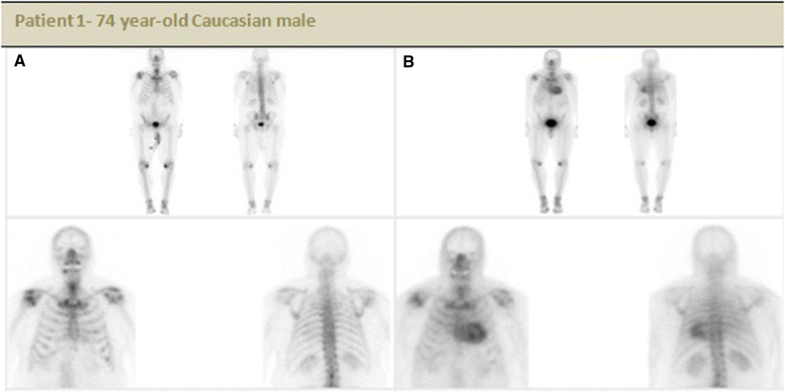Cardiac ATTR amyloid nuclear imaging—not all bone scintigraphy ...