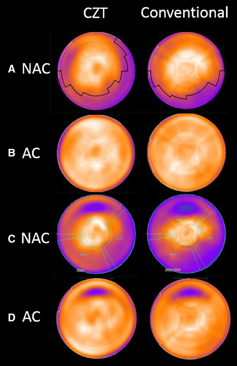 Differences in attenuation pattern in myocardial SPECT between CZT and ...