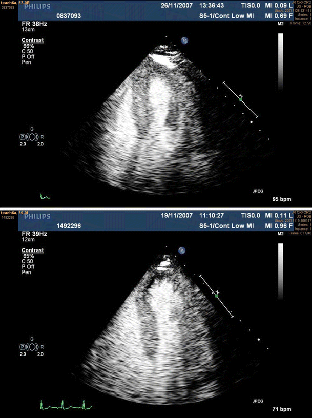 Contrast Echocardiography: Current Applications and Future Perspectives ...