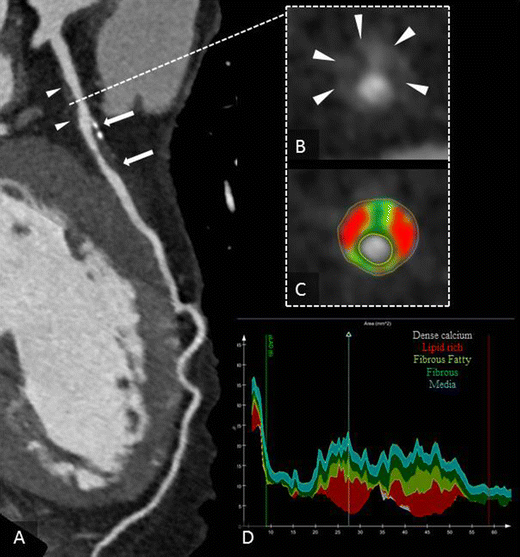 High Risk Plaque Features on Coronary CT Angiography | SpringerLink