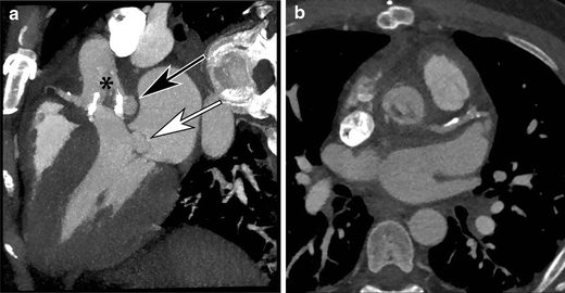 The Role of Cardiac CT in the Evaluation of Endocarditis | SpringerLink
