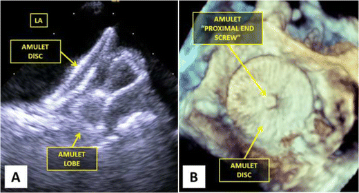 Percutaneous Left Atrial Appendage Closure Devices | SpringerLink
