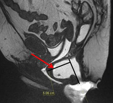 De bekkenbodem belicht | SpringerLink