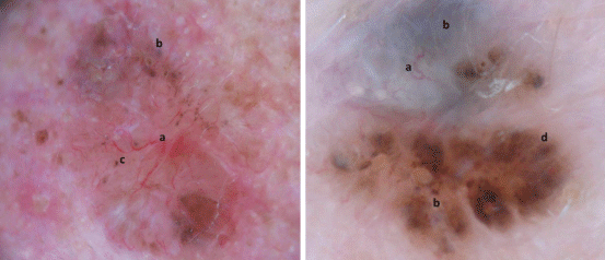 Diagnostiek, behandeling en nazorg van het basaalcelcarcinoom ...