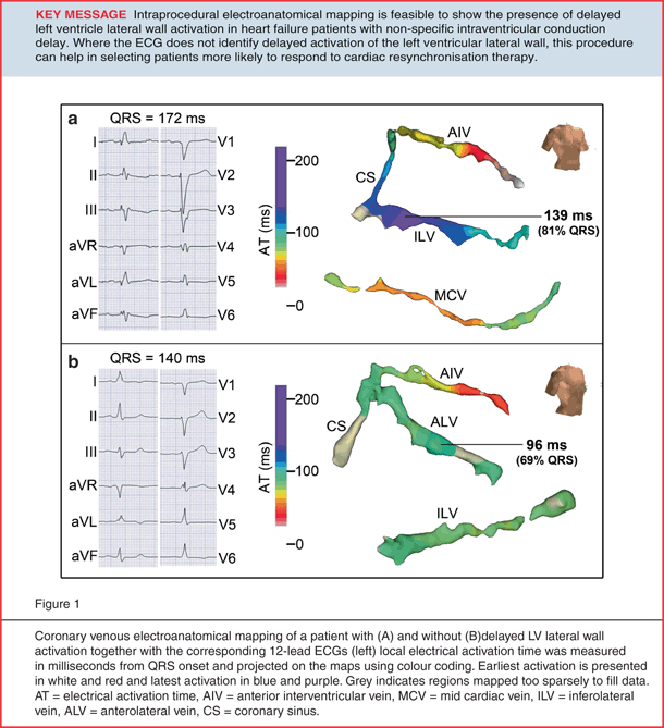 Identifying delayed left ventricular lateral wall activation in ...