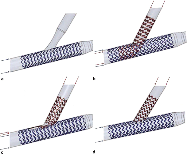 Evaluation of bifurcation stenting techniques at Catharina Hospital ...