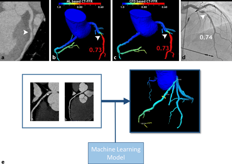 Artificial intelligence in cardiovascular imaging: state of the art and ...