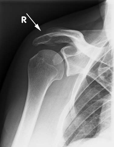 Een geïsoleerde acromionfractuur | SpringerLink