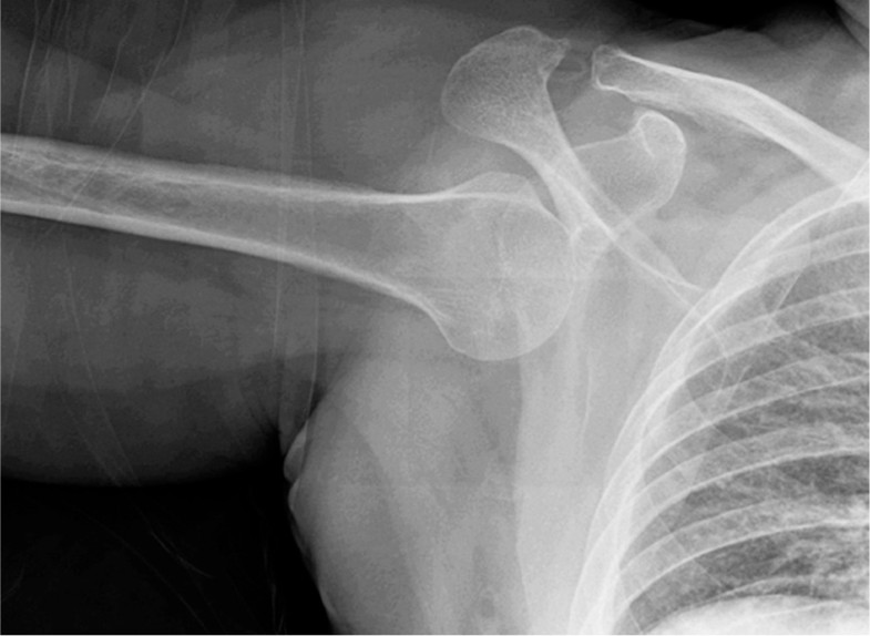 Luxatio erecta | SpringerLink