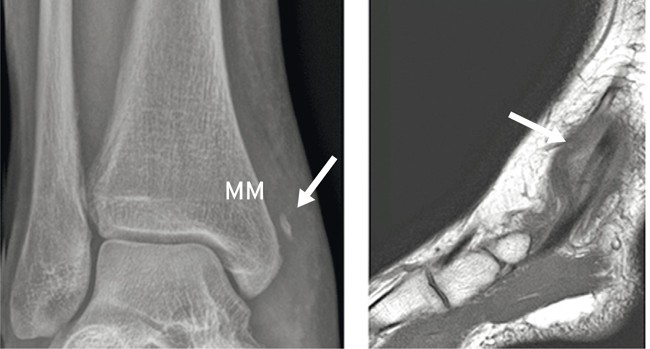 De onverwachte uitkomst van een enkeldistorsie | SpringerLink