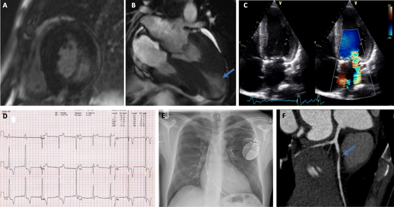 Anderson-Fabry disease in heart failure | SpringerLink