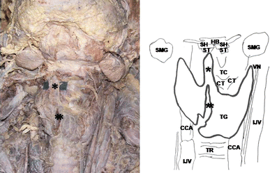 Variations in the anatomy of the thyroid gland: clinical implications ...