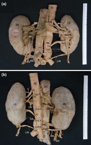 Nine renal arteries in a Japanese female cadaver | SpringerLink