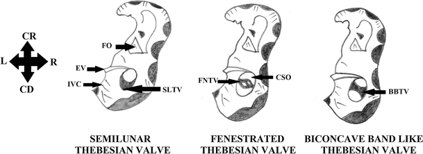 Obstructive Thebesian valve: anatomical study and implications for ...