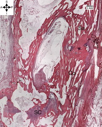 The anatomy of the sacrococcygeal cornual region and its clinical ...