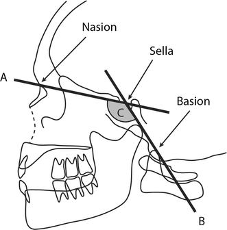 Identification of the posterior deep temporal nerve groove and canal ...
