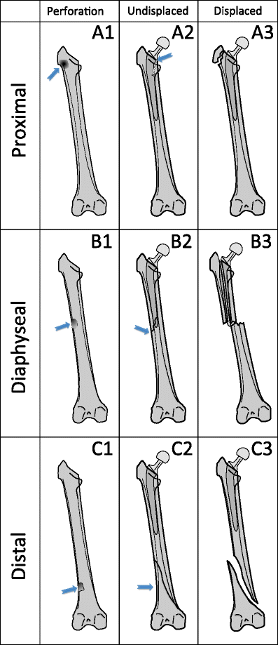 Intraoperative periprosthetic hip fractures | SpringerLink