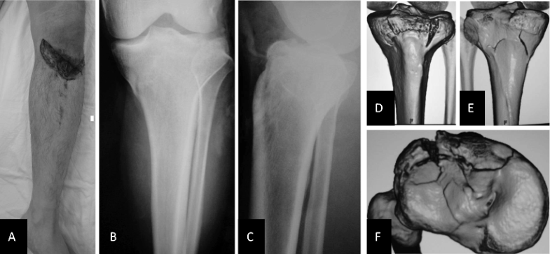 Fixation for the open proximal tibia fracture approached by ...