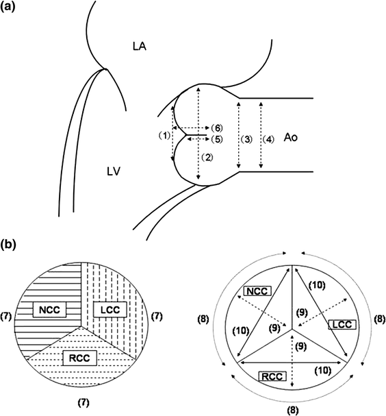 Sinus of Valsalva dilates disproportionately in aortic root aneurysm ...
