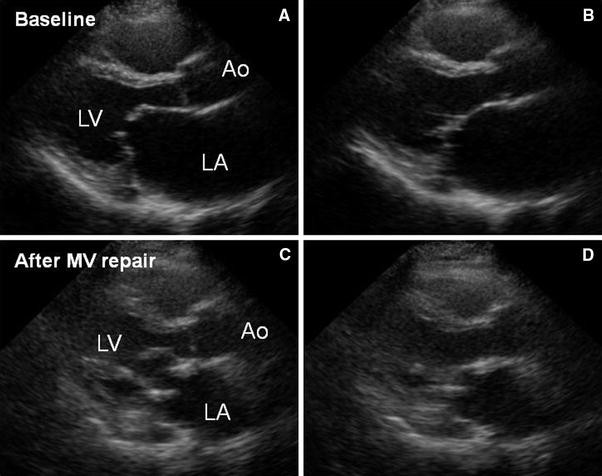 Reconsiderations of mitral stenosis: rheumatic mitral valve repair and ...