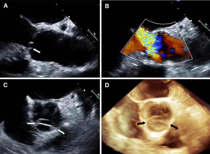 Aortic regurgitation caused by cusp bending of aortic valve leaflet ...