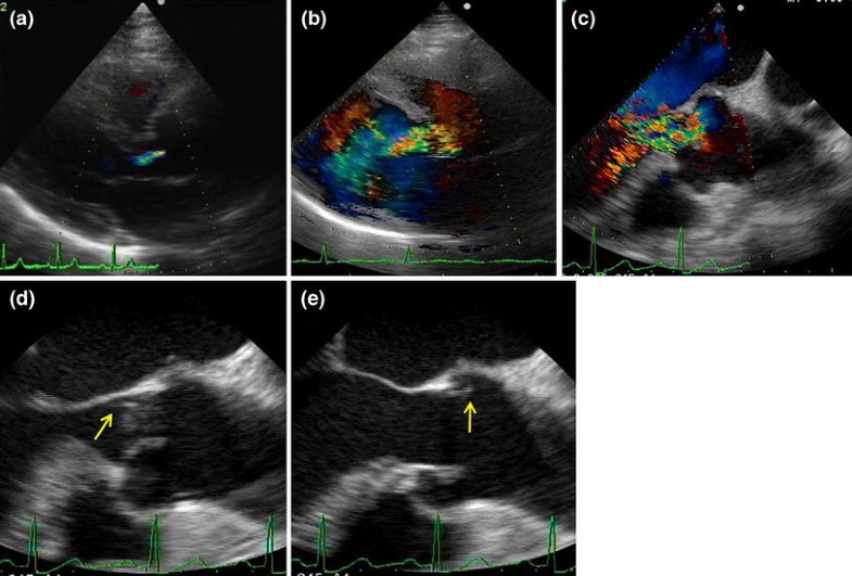 Aortic regurgitation caused by fibrous strand rupture in a fenestrated ...