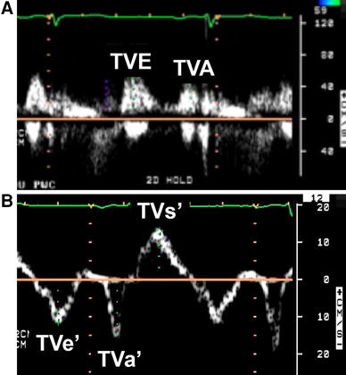 Usefulness of right ventricular tissue Doppler imaging for diagnosis of ...