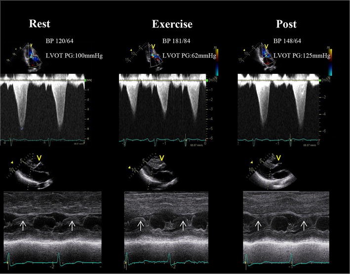 Exercise stress echocardiography in hypertrophic cardiomyopathy ...